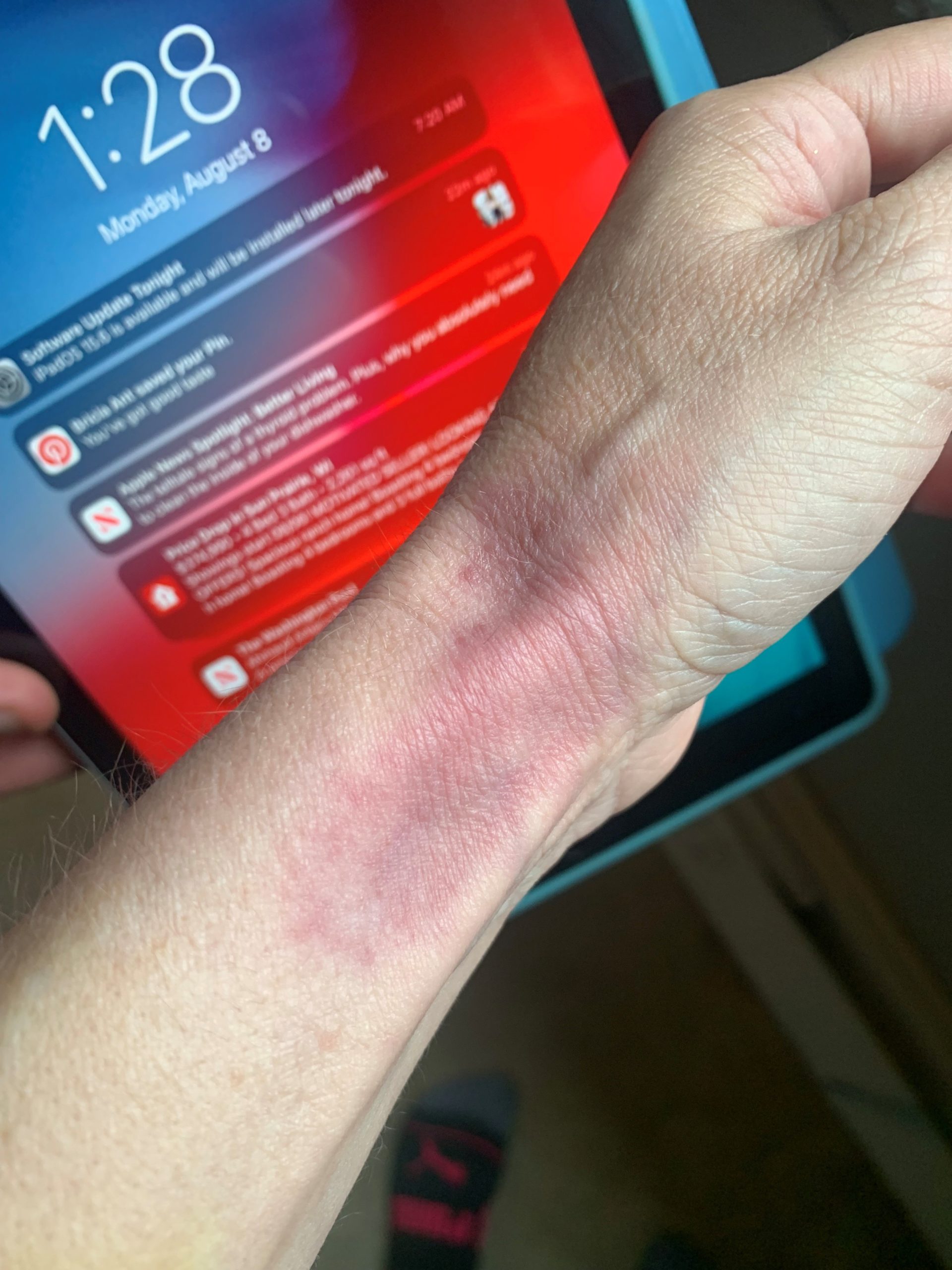 PLG Settles Case for Woman Who Suffered Burn Injury at Local Resort ...