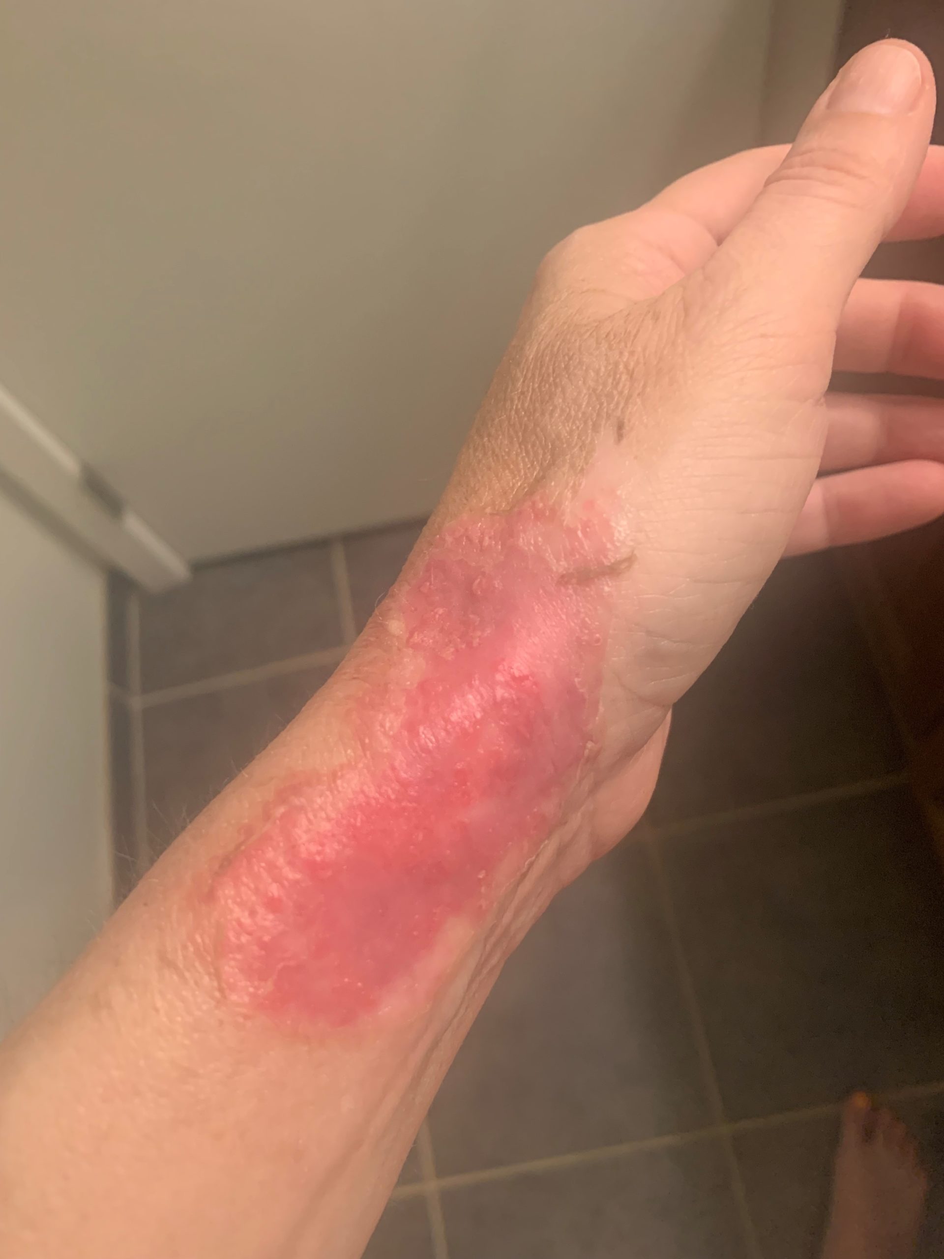 PLG Settles Case for Woman Who Suffered Burn Injury at Local Resort ...