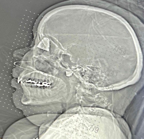 Steering Wheel Emblem Bling Decal Injuries Explained by Our Car ...